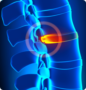 Herniated Bulging Disc | EndoSpine | Leaders in Endoscopic Spine Surgery